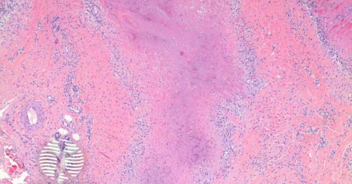 Rheumatoid nodule pathology image