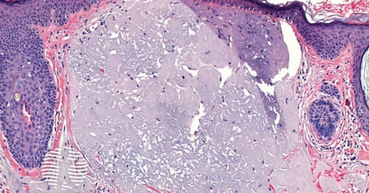 Favre-Racouchot syndrome image