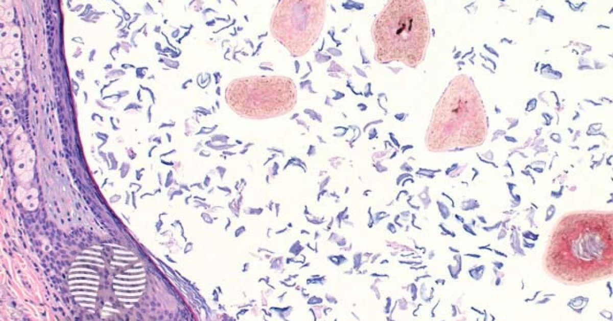 Primary cutaneous amyloidosis pathology image