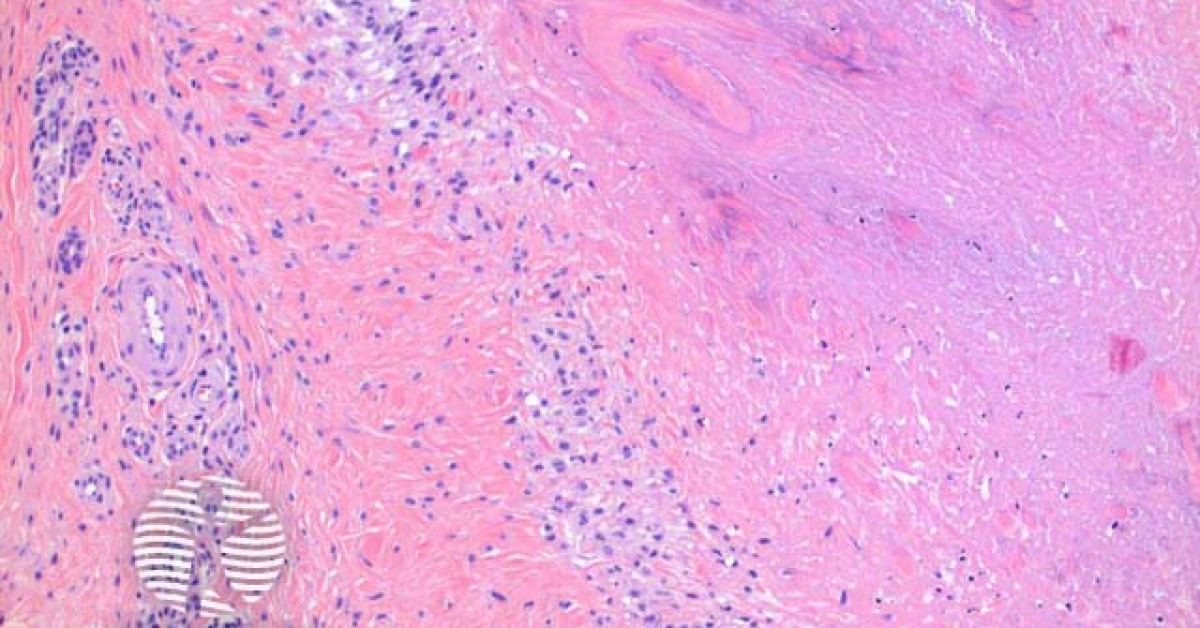 Rheumatoid nodule pathology image