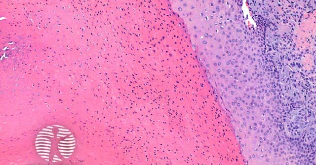 Trichilemmal cyst pathology image