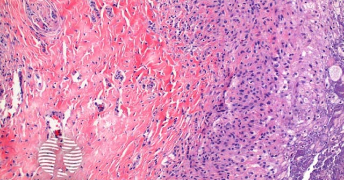 Phaeohyphomycosis pathology image