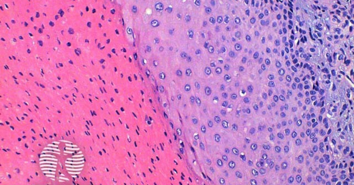 Trichilemmal cyst pathology image
