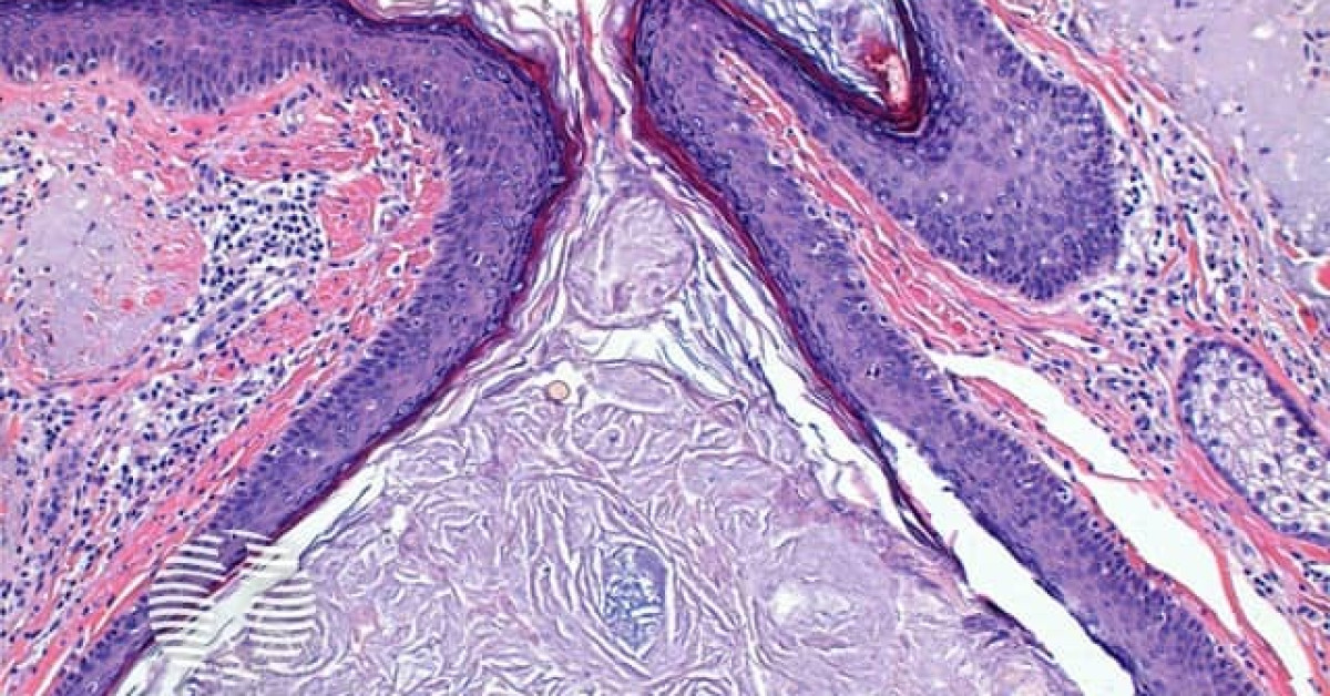 Favre-Racouchot syndrome image