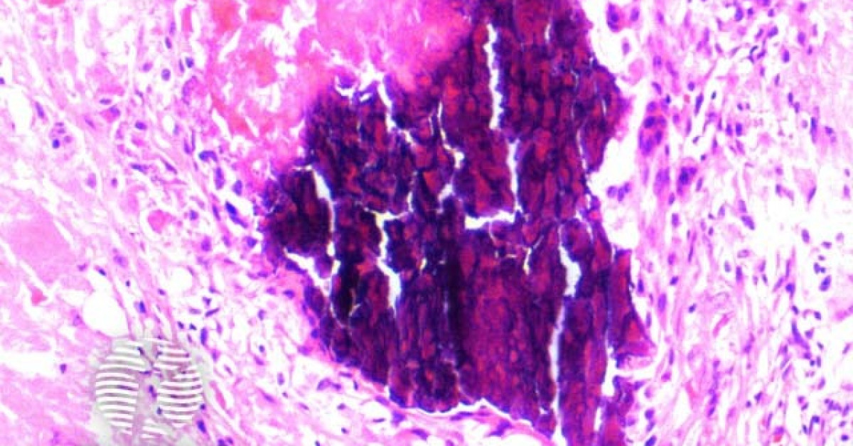 Trichilemmal cyst pathology image