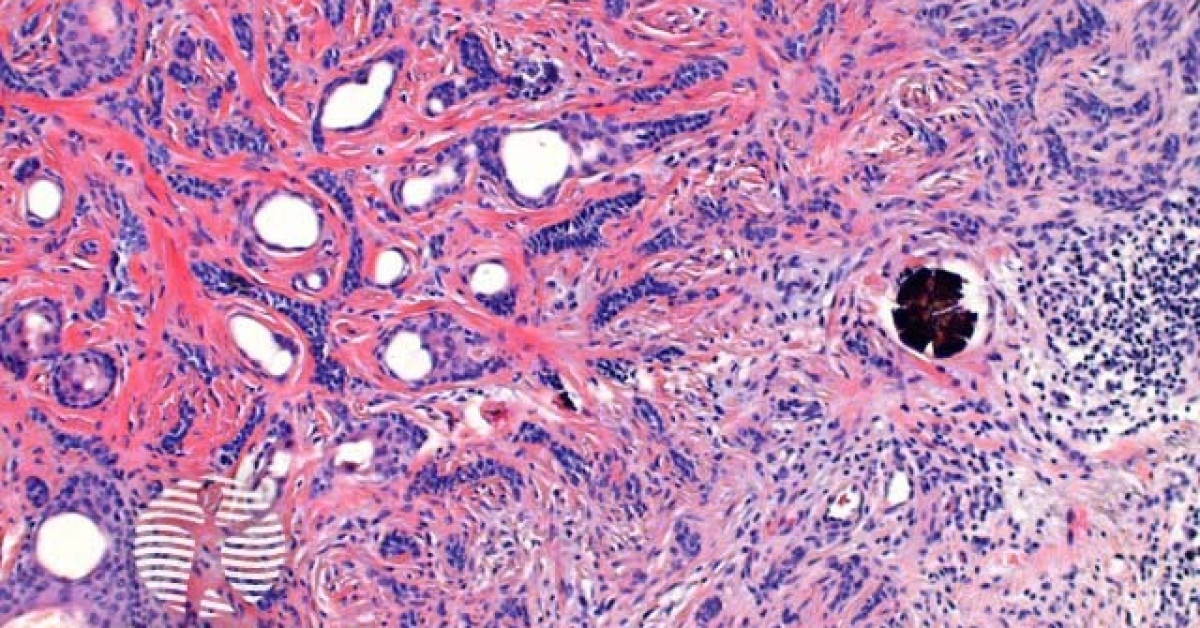 Desmoplastic trichoepithelioma pathology image