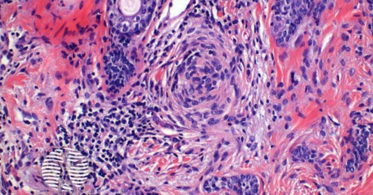 Desmoplastic trichoepithelioma pathology image