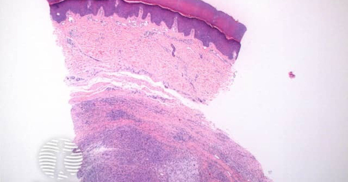 Giant cell tumour of tendon sheath pathology image