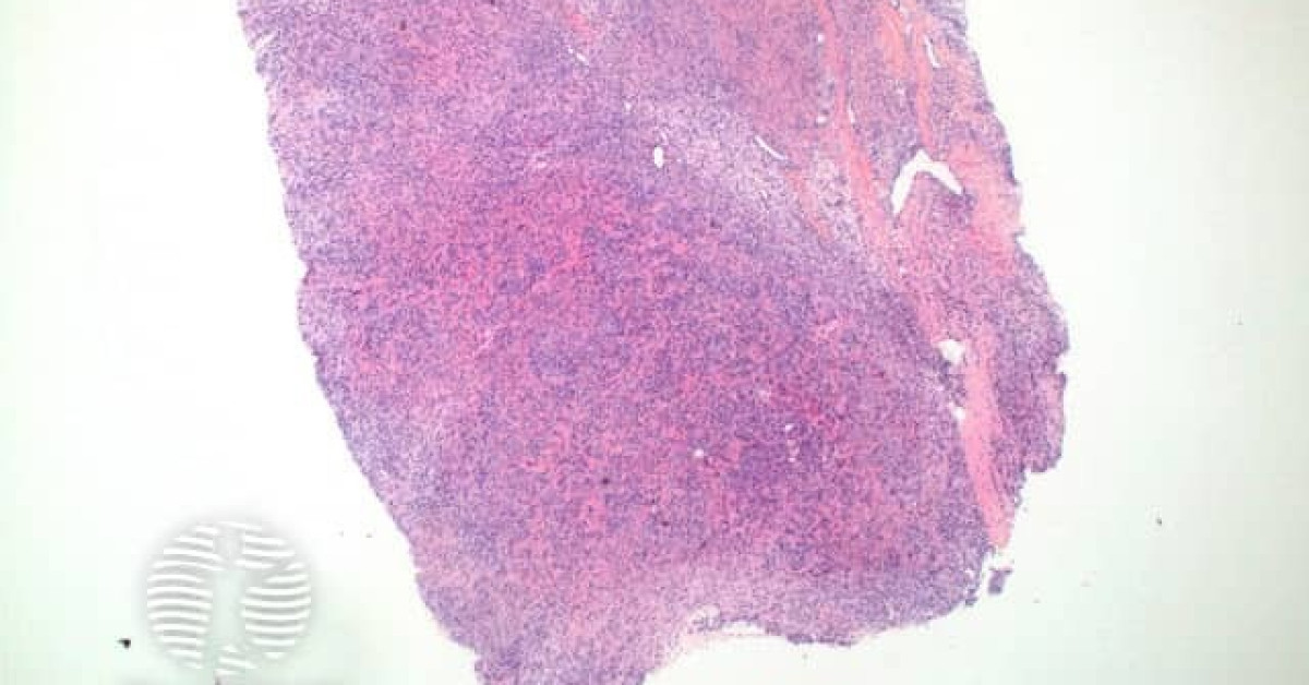 Giant cell tumour of tendon sheath pathology image