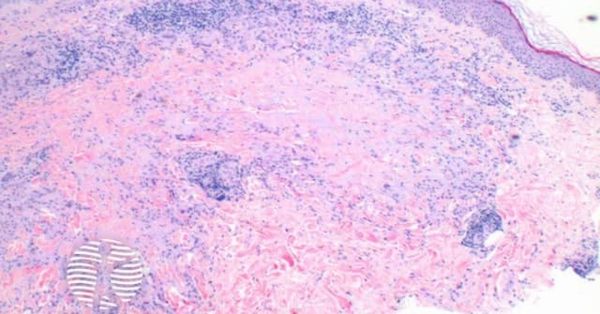 Granuloma annulare pathology image