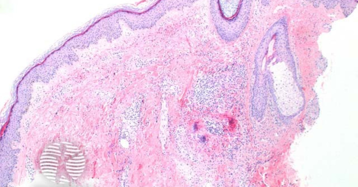 Leukocytoclastic vasculitis pathology image