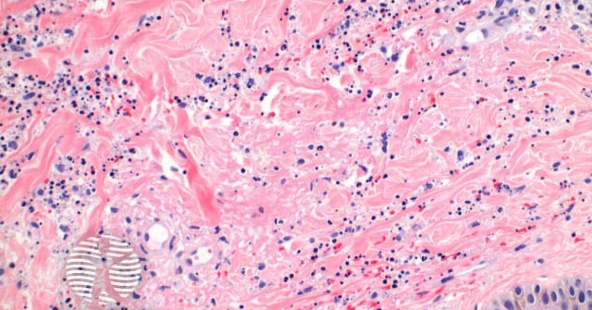 Leukocytoclastic vasculitis pathology image
