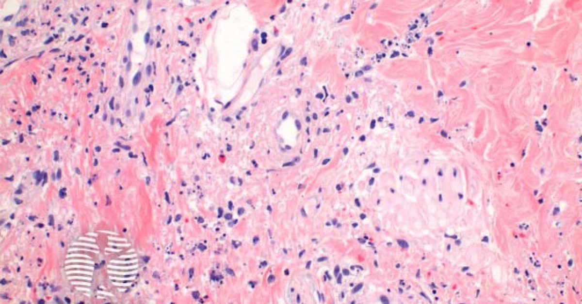 Leukocytoclastic vasculitis pathology image