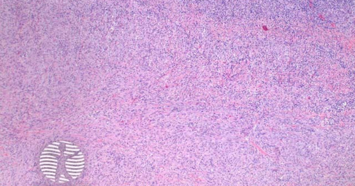 Leiomyosarcoma pathology image