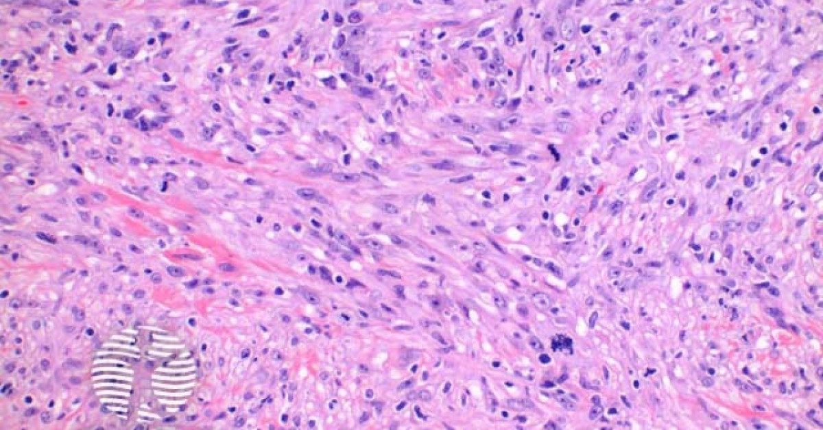 Leiomyosarcoma pathology image