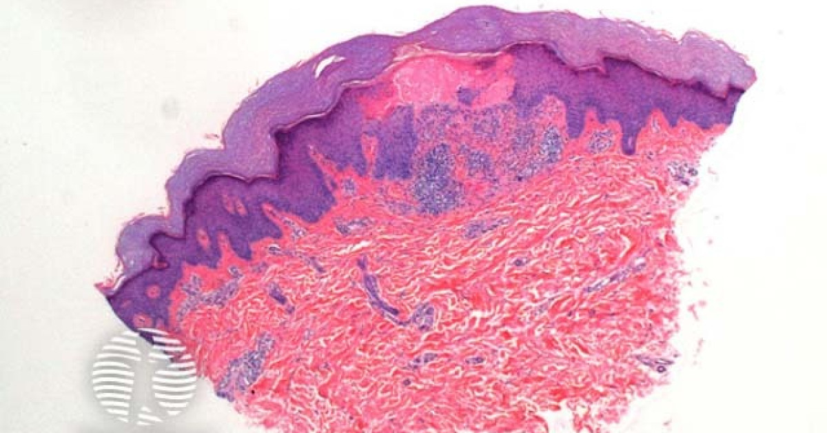 Lichen nitidus pathology image
