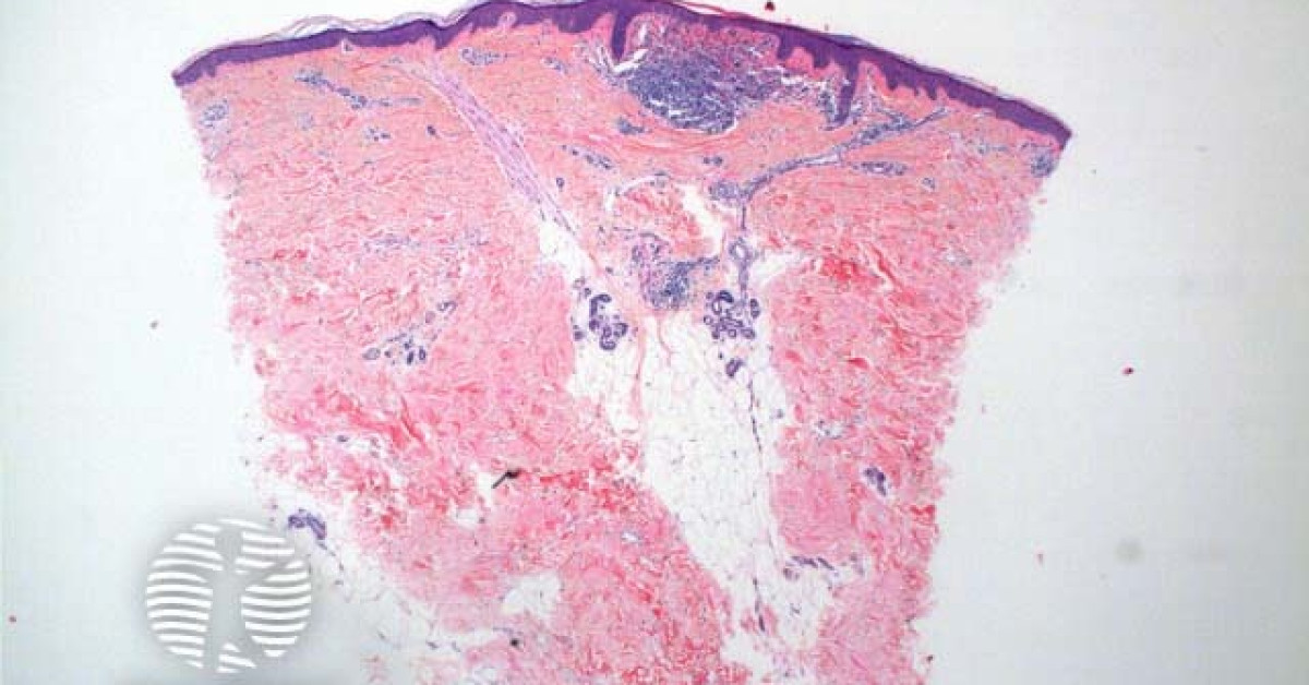 Lichen nitidus pathology image