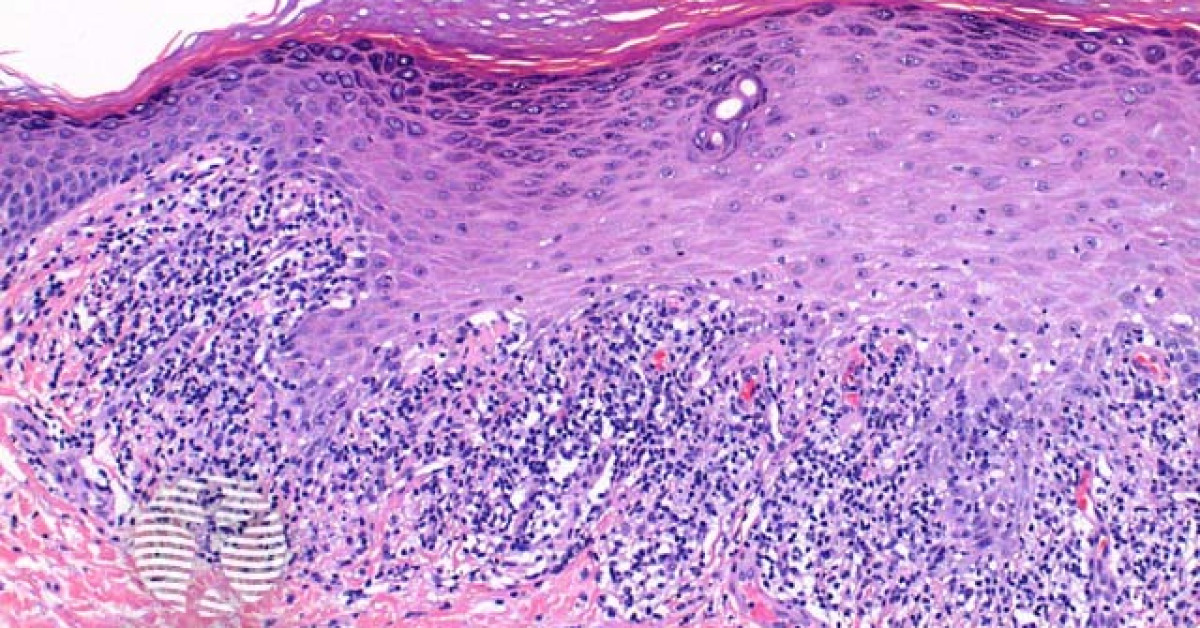 Lichen planus pathology image