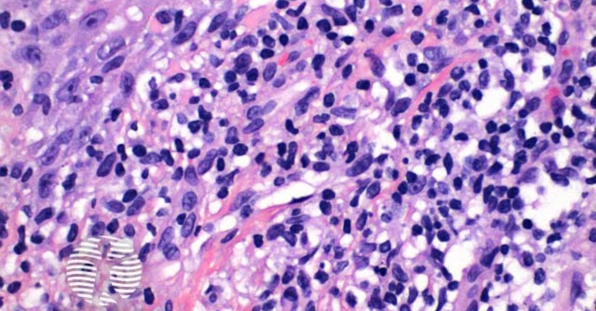 Lichen planus pathology image