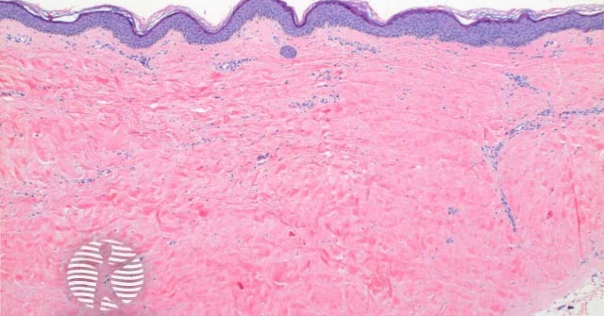 Lichen sclerosus pathology image