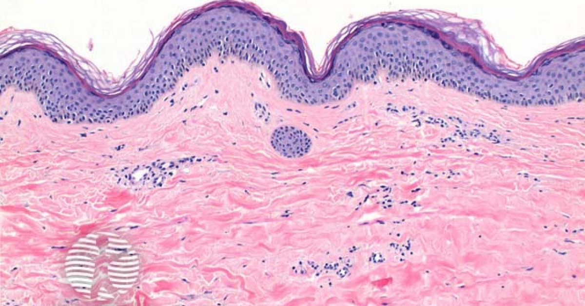 Lichen sclerosus pathology image