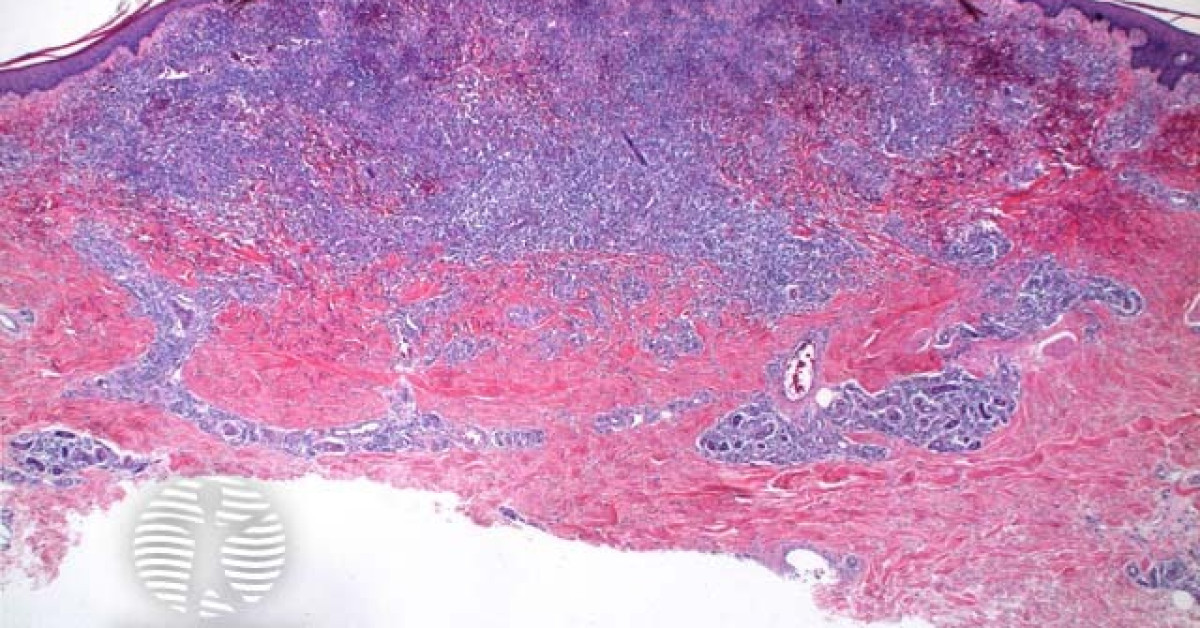 Lymphomatoid papulosis pathology image