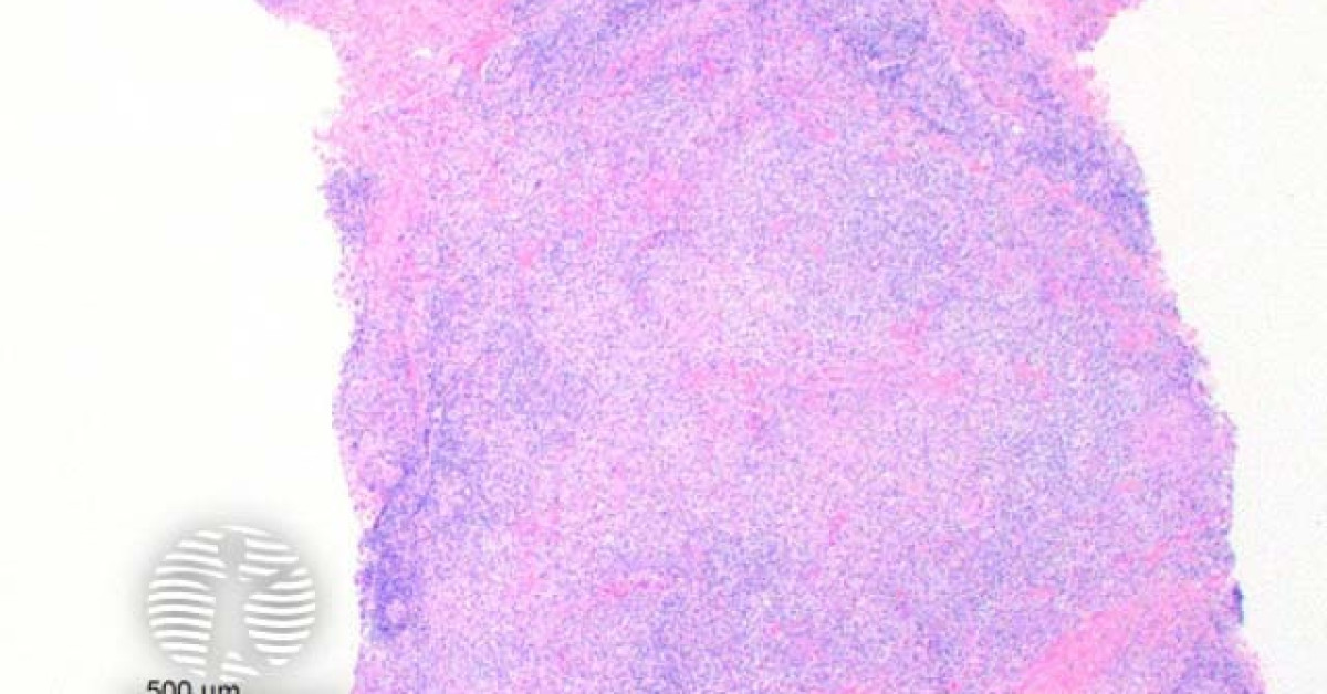 Mycobacterium marinum skin infection pathology image