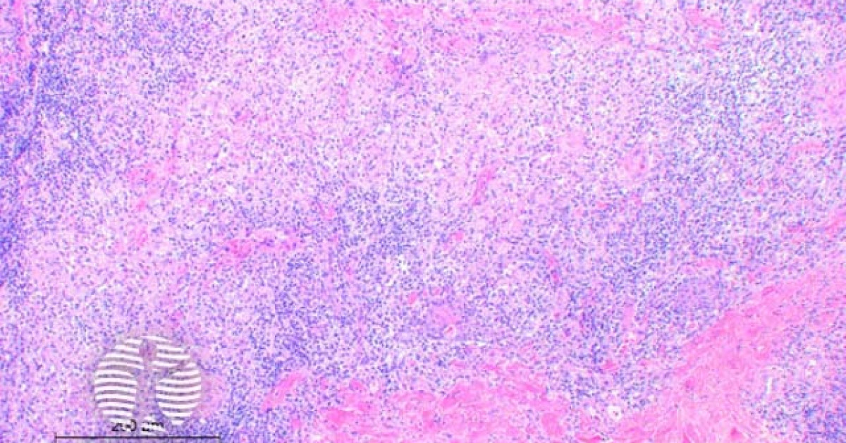 Mycobacterium marinum skin infection pathology image