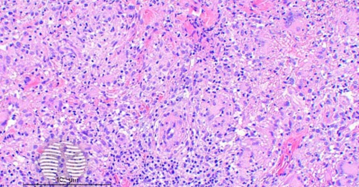 Mycobacterium marinum skin infection pathology image