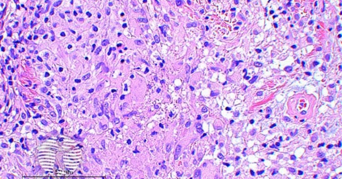 Mycobacterium marinum skin infection pathology image