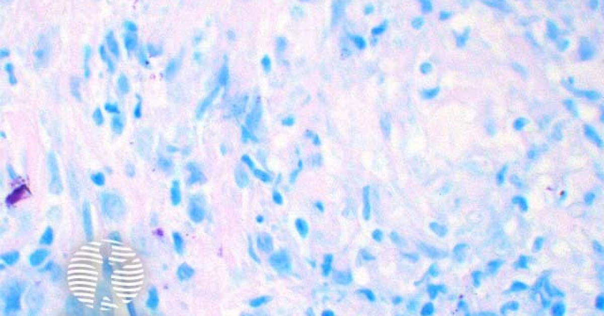 Mycobacterium marinum skin infection pathology; Ziehl-Neelsen stain image