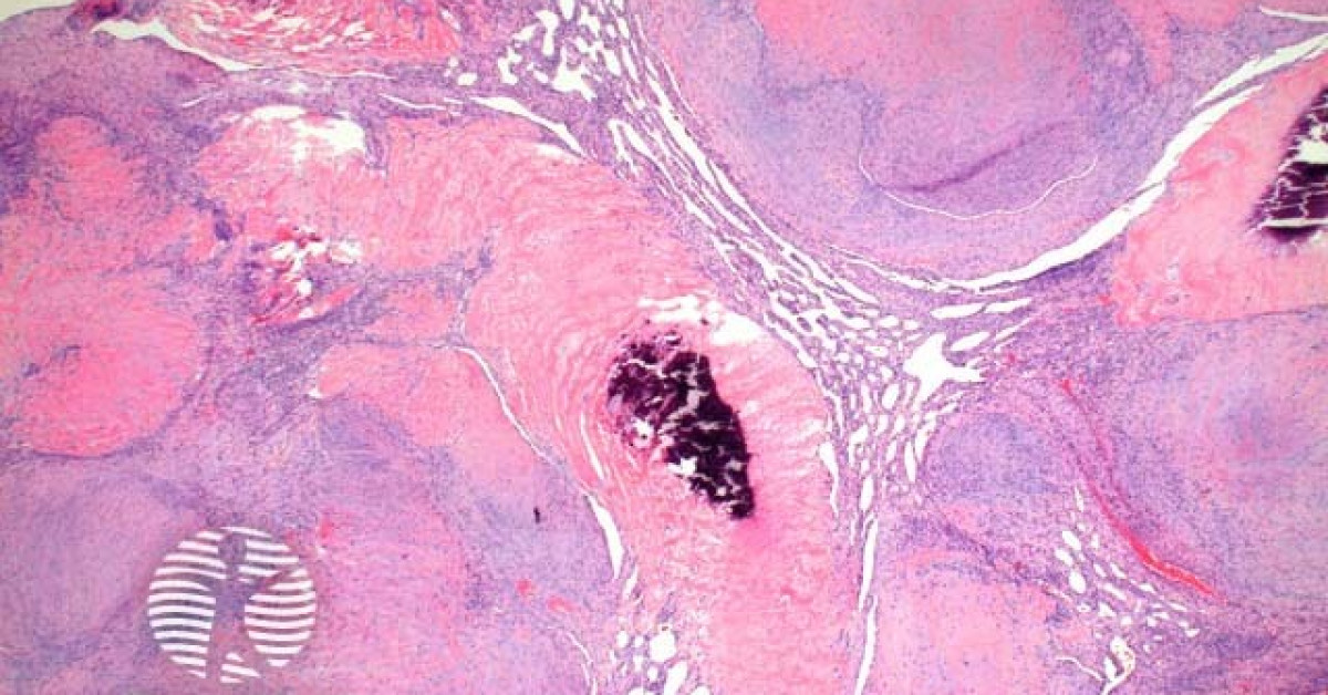Myofibroma pathology image