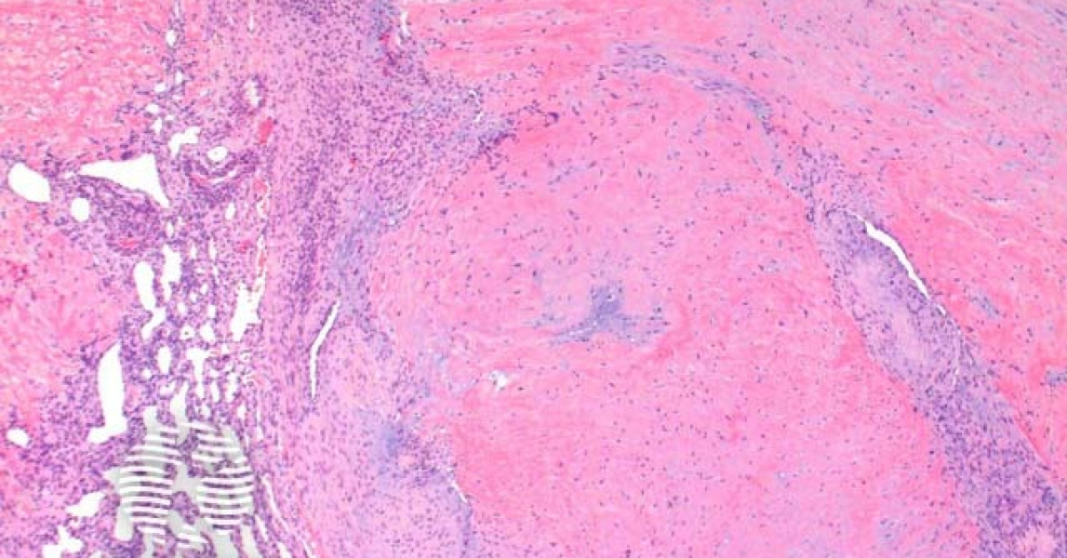 Myofibroma pathology image