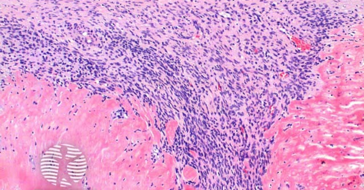 Myofibroma pathology image