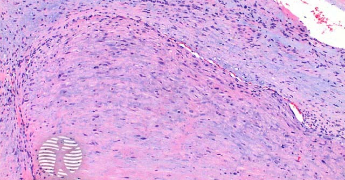 Myofibroma pathology image