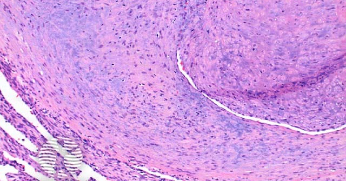 Myofibroma pathology image