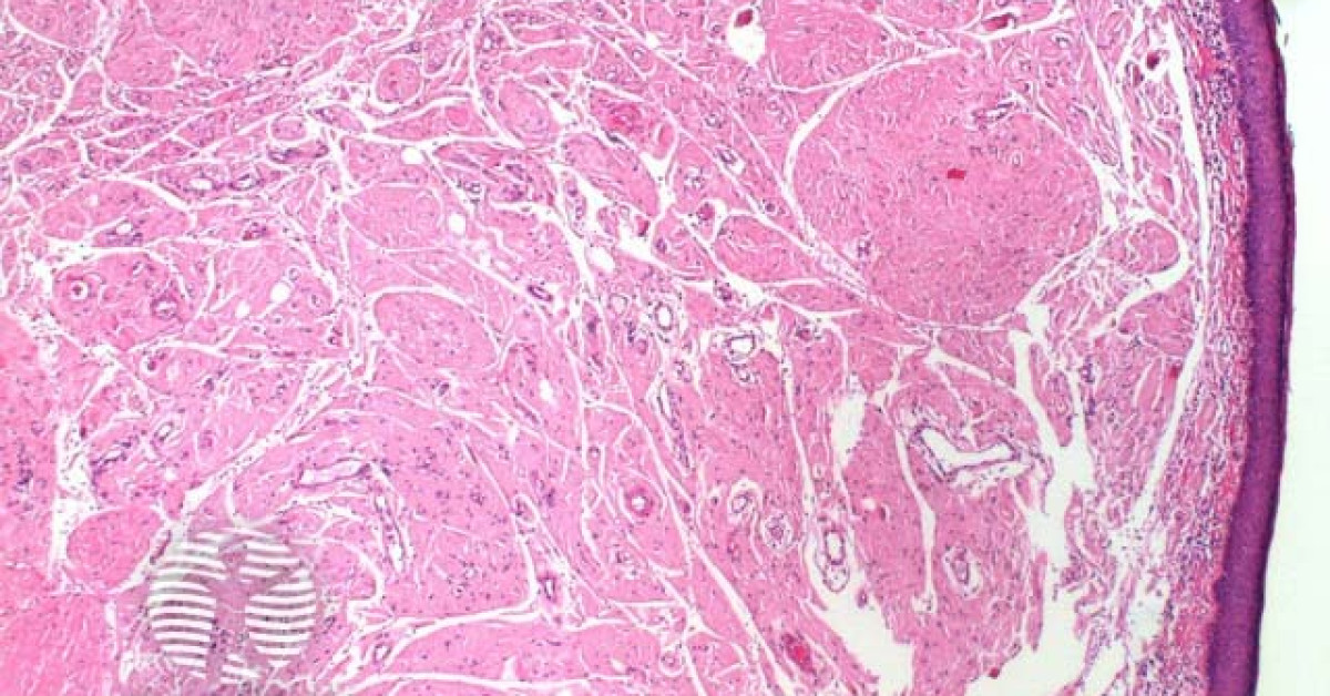 Primary cutaneous amyloidosis pathology image