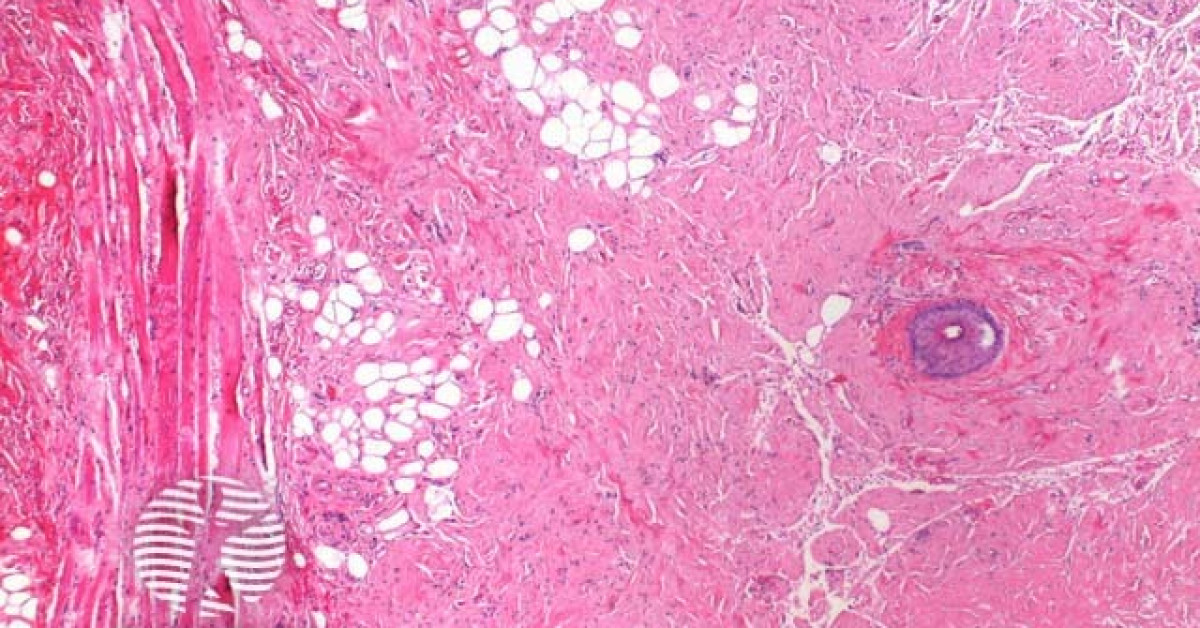 Primary cutaneous amyloidosis pathology image