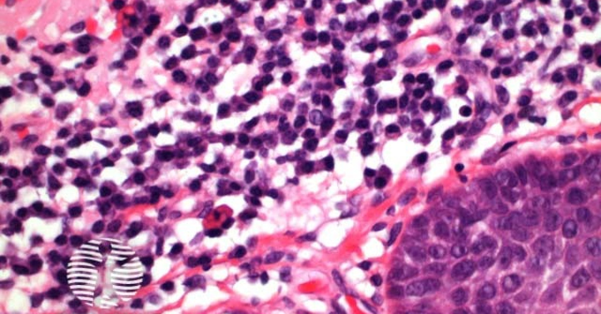 Primary cutaneous amyloidosis pathology image