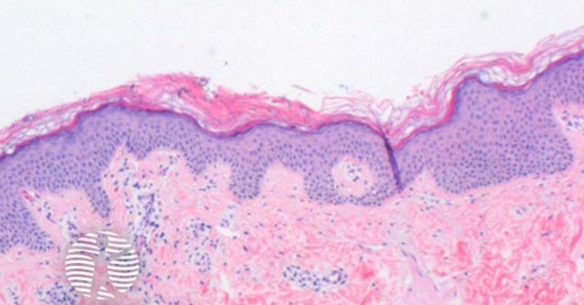 Pityriasis versicolor pathology image