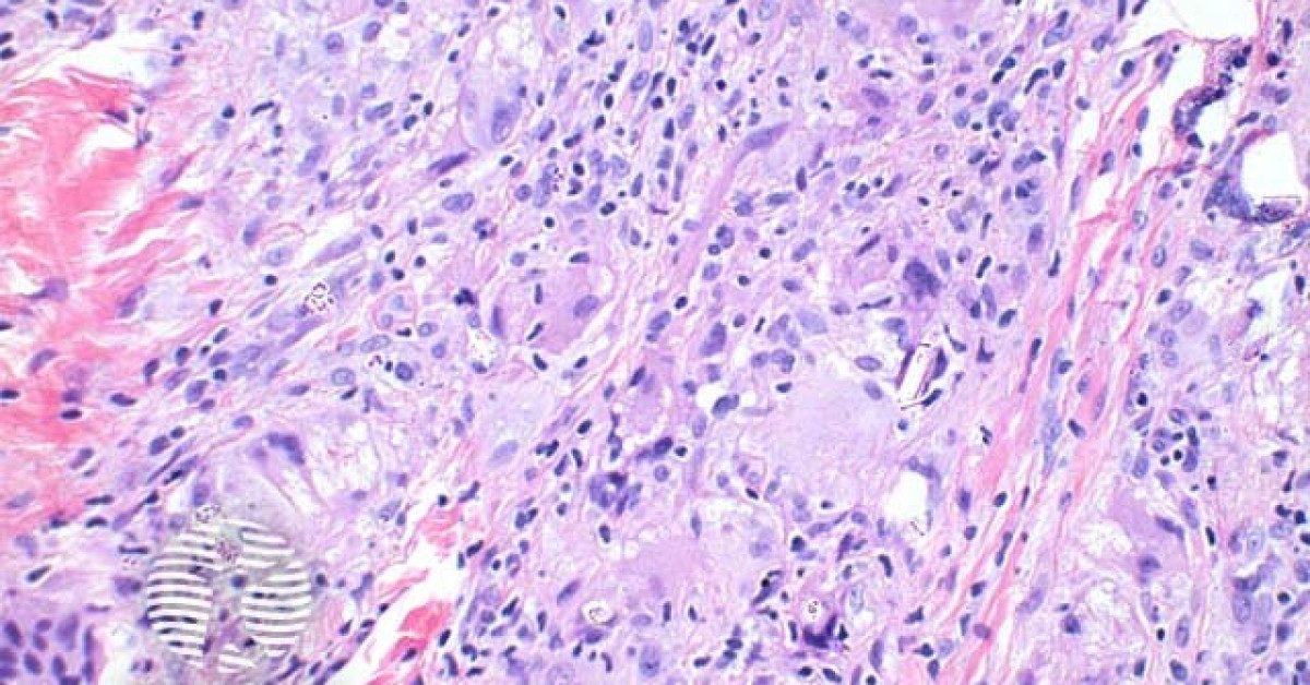 Sarcoidosis pathology image