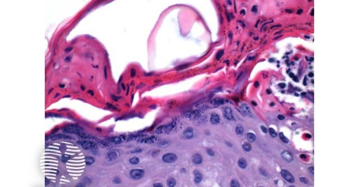 Scabies pathology image