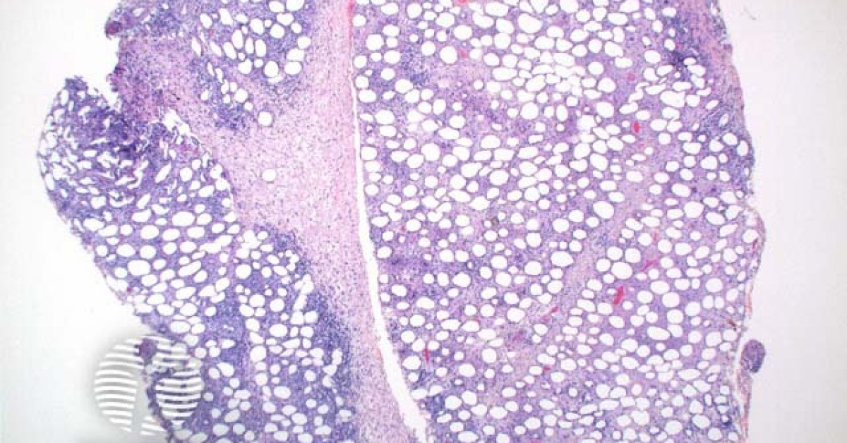 Subcutaneous panniculitis-like T-cell lymphoma pathology image