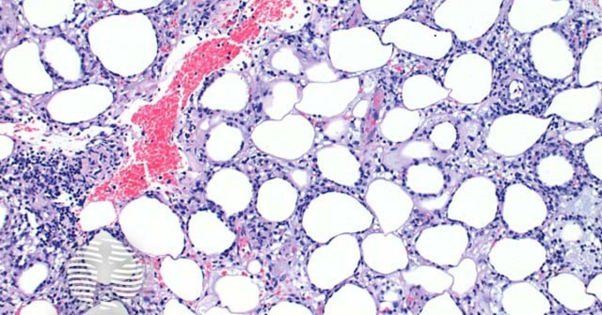 Subcutaneous panniculitis-like T-cell lymphoma pathology image