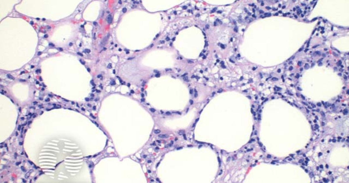Subcutaneous panniculitis-like T-cell lymphoma pathology image
