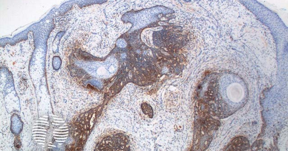 Trichoepithelioma pathology, BCL-2 stain image