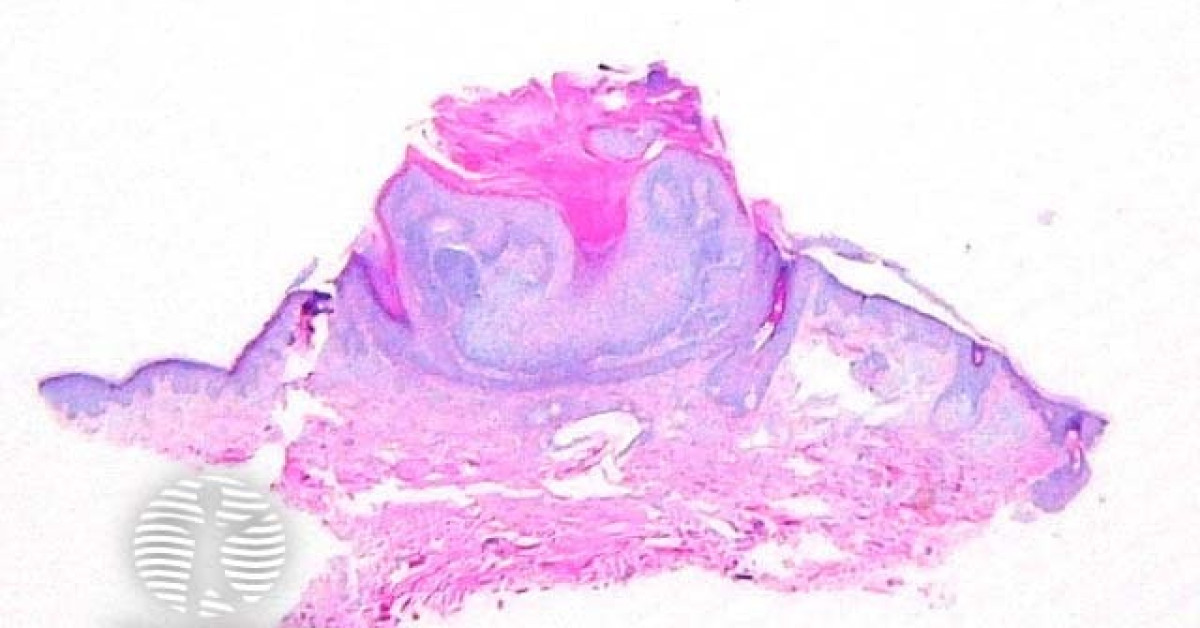 Trichilemmoma pathology image