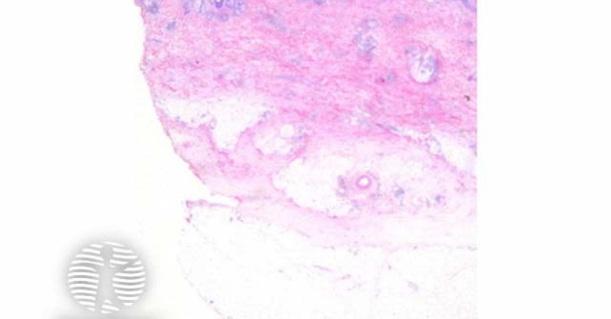 Wells syndrome pathology image