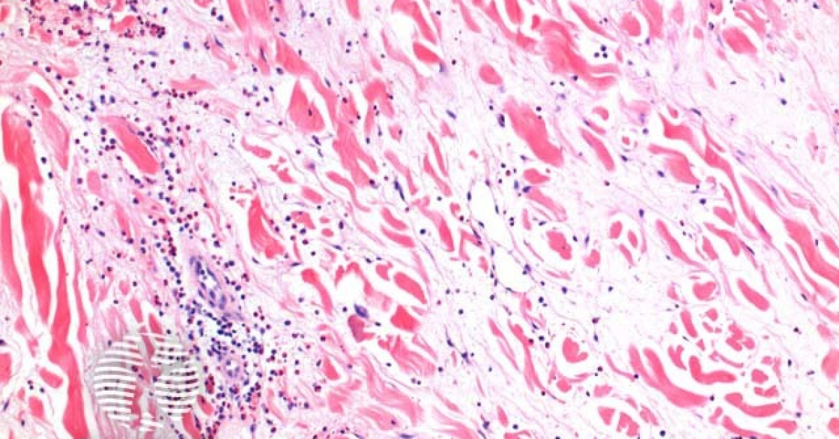 Wells syndrome pathology image