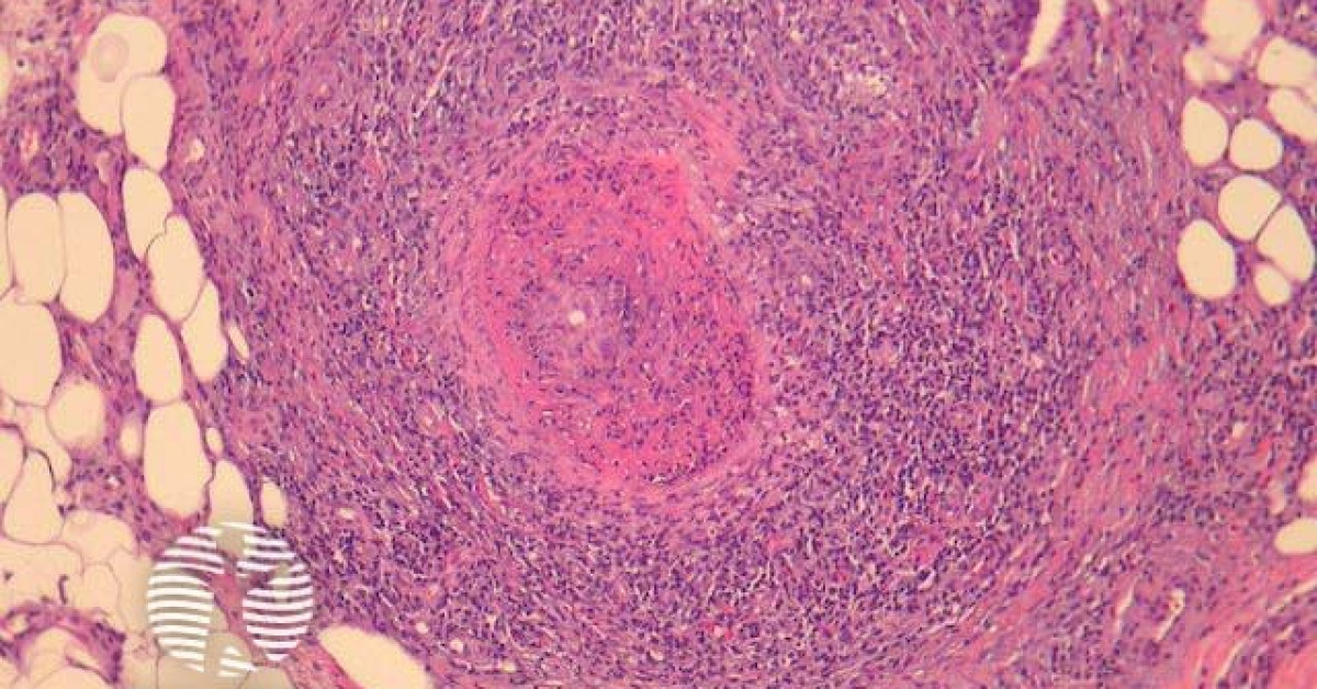 Polyarteritis nodosa pathology image